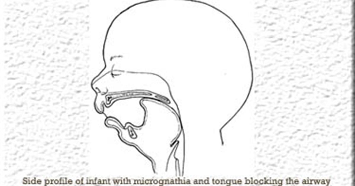 Micrognathia & Pierre Robin Sequence - HealthyChildren.org