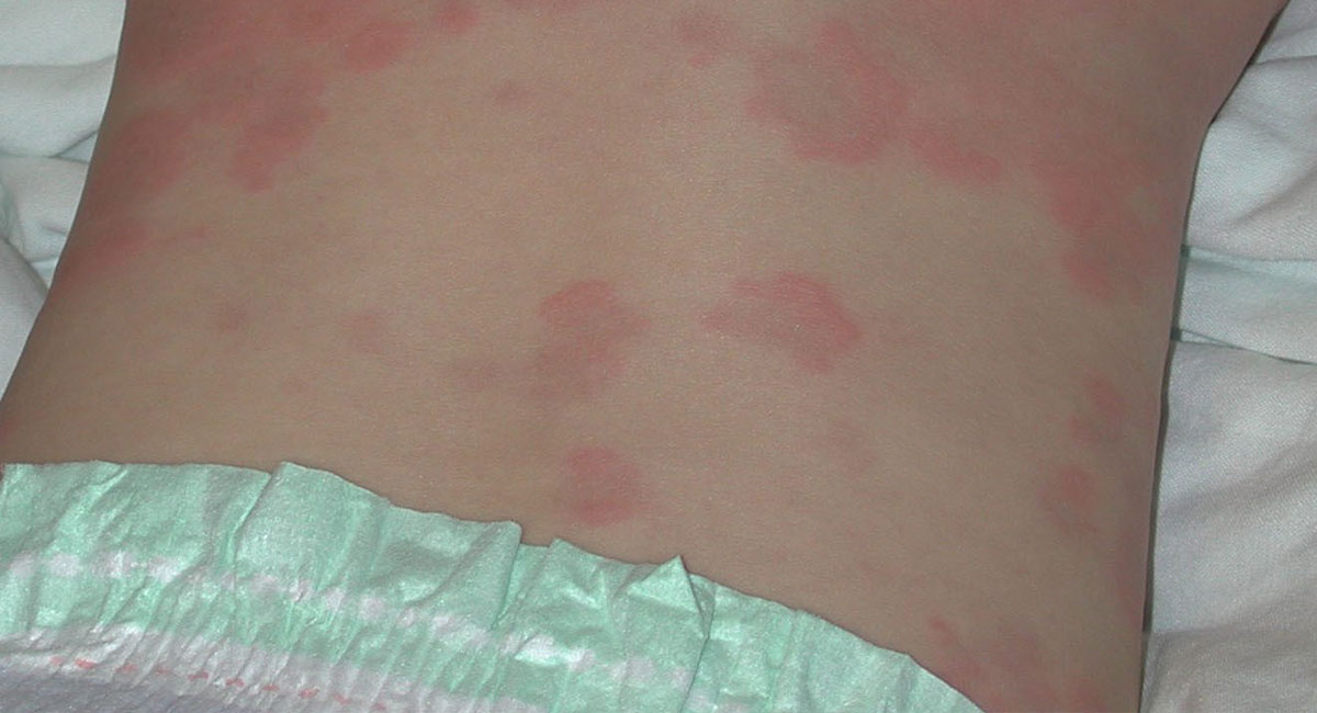 Hives Urticaria In Children HealthyChildren Hives Urticaria In Children HealthyChildren